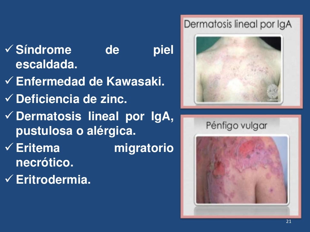 Stevens Johnson Y Necrolisis Epidermica Toxica