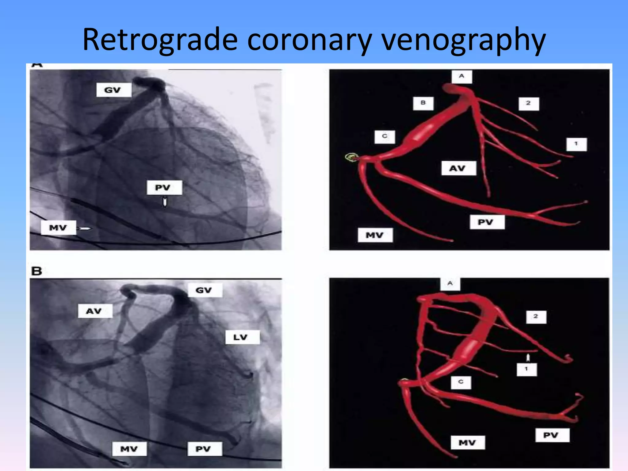 Second Step of Coronary Angiography | PPT