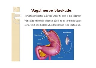 Sthaulya-roga-obesity-for-class-ayurveda-61-638 (12 files merged) (1).ppt
