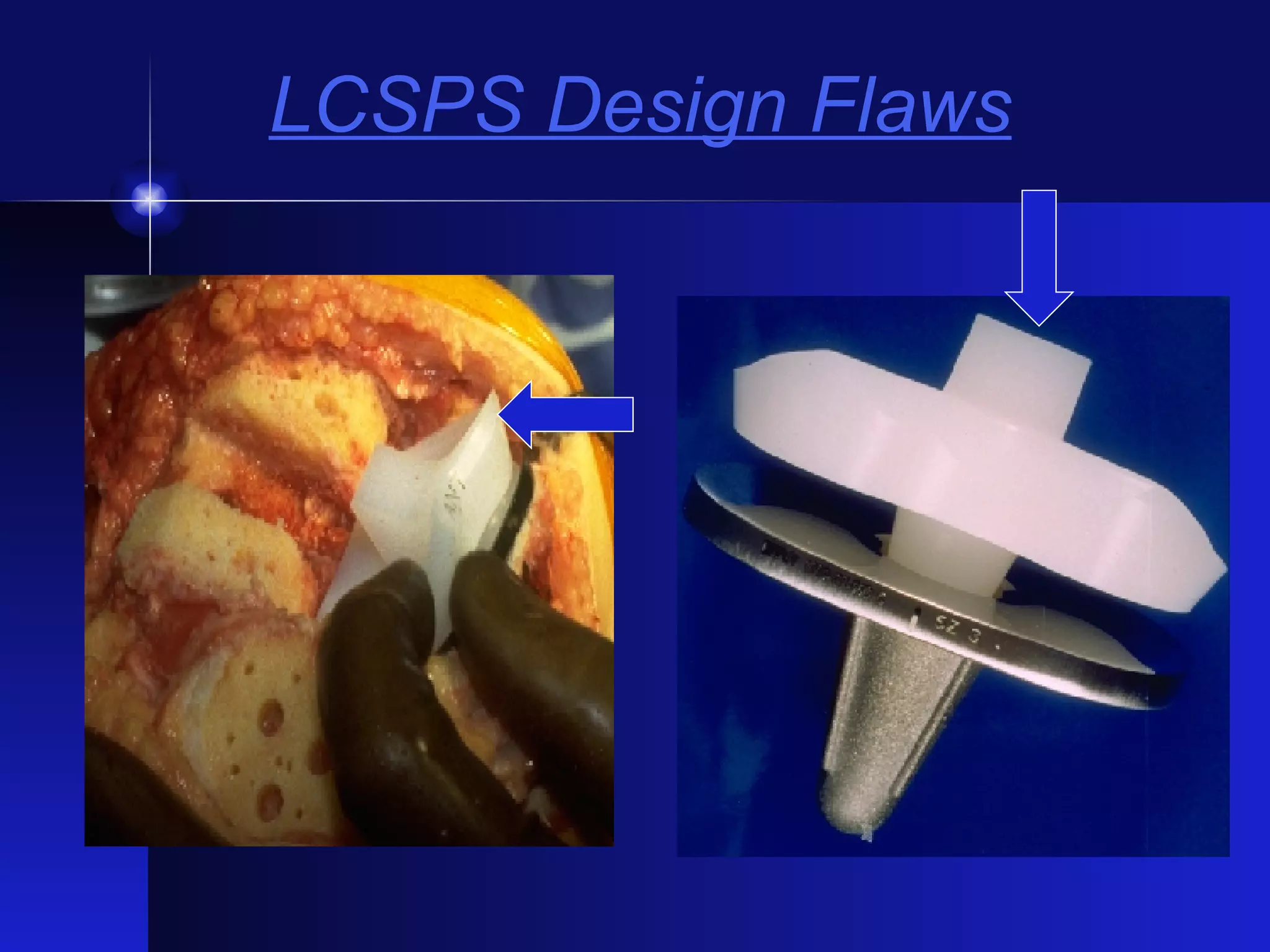 Stiehl Jb. Design Factors Influencing Rom In Tka | PPT | Death, Injury ...