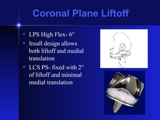 Stiehl Jb. Is Ps Needed In Tka | PPT