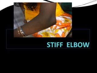Stiff elbow and fffd elbow managememt | PPT