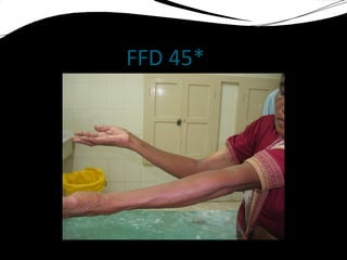 Stiff elbow and fffd elbow managememt | PPT