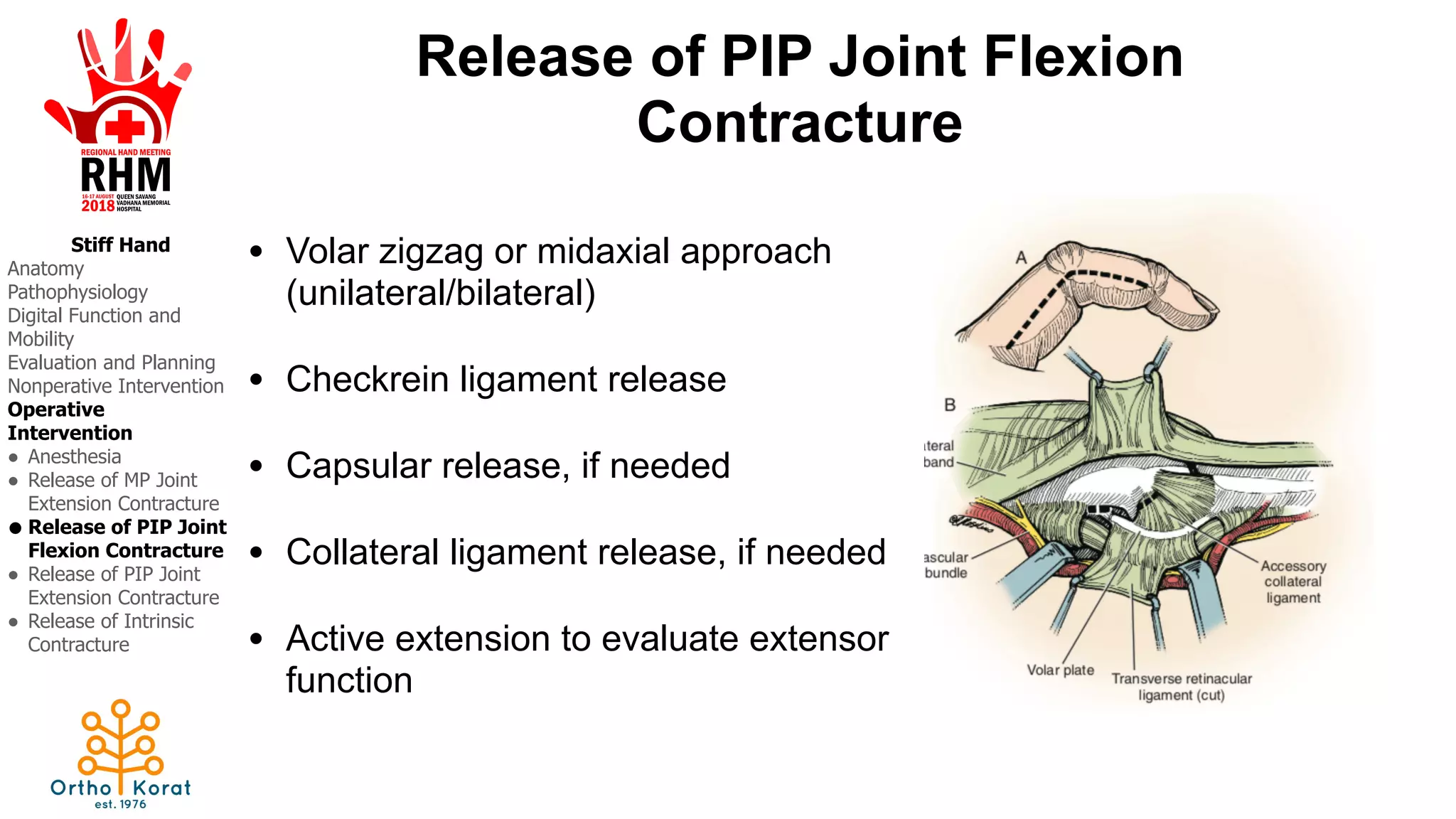 Stiff Finger | PPT