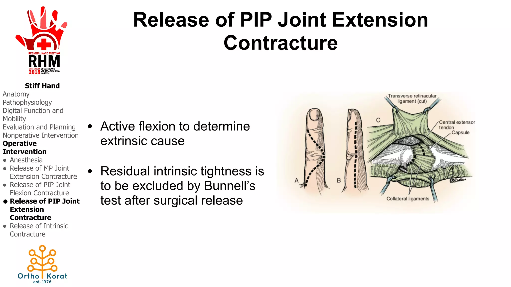 Stiff Finger | PPT