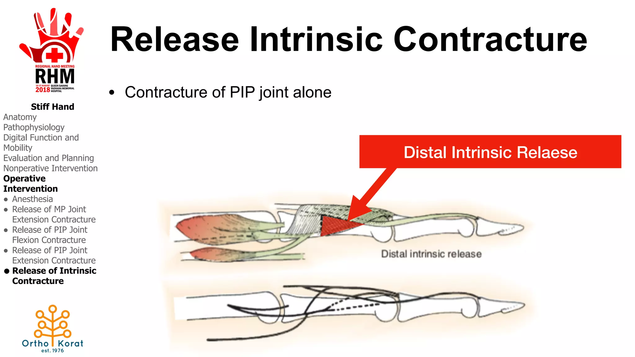 Stiff Finger | PPT