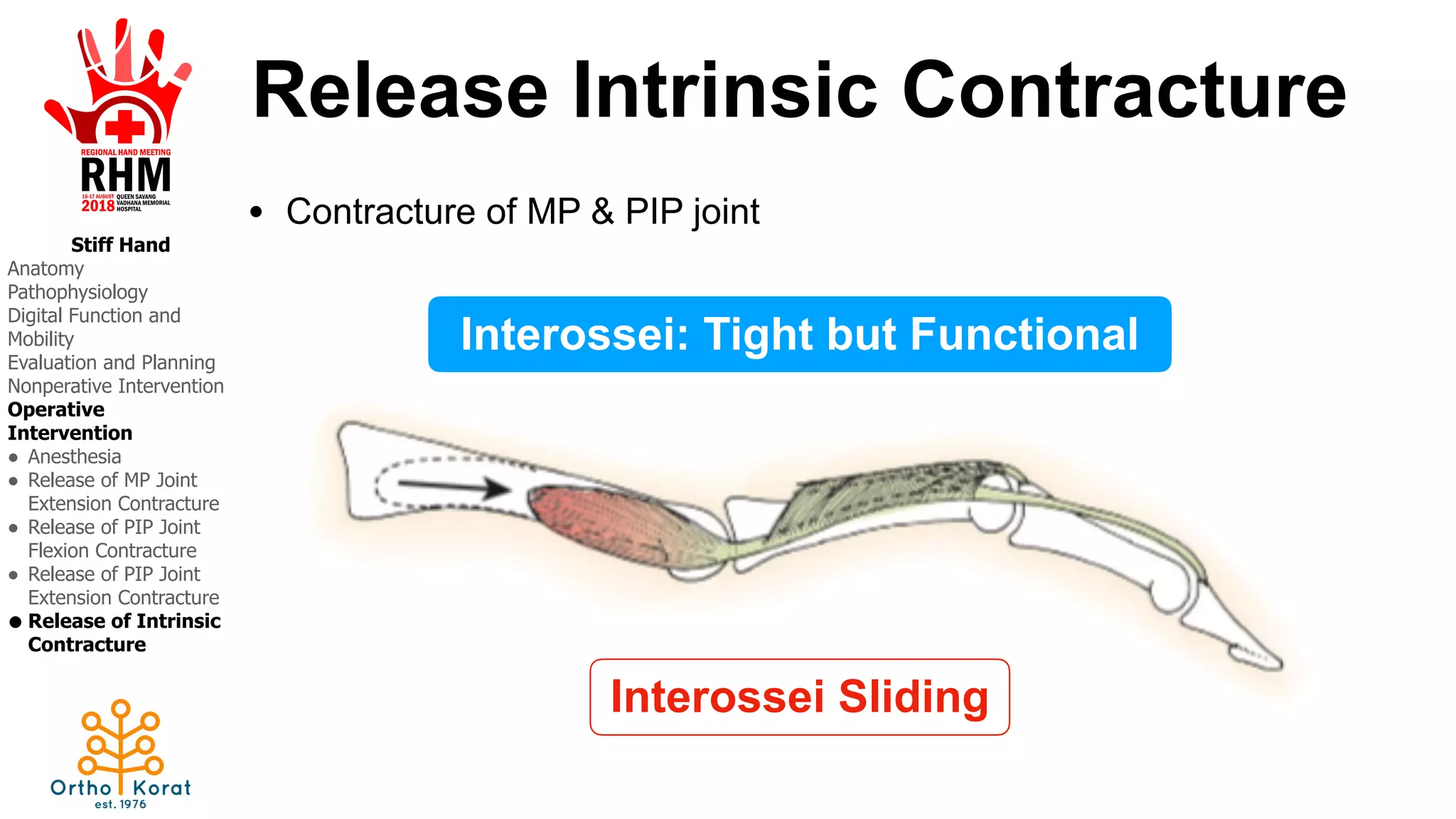 Stiff Finger | PPT