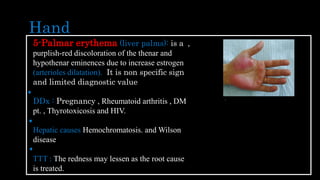 Presentation for stigmata of liver ppt.pptx
