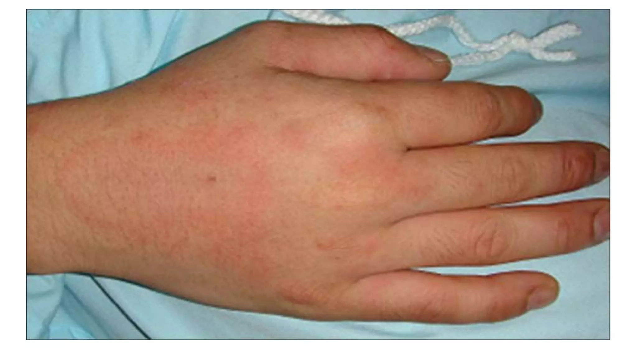 Still's disease | PPTX