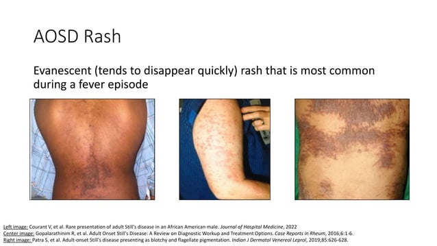 Adult-Onset Still's Disease | PPTX