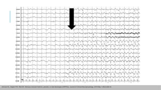 Stimulus Induced Rhythmic, Periodic, or Ictal Discharges | PPTX | Brain ...