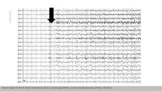 Stimulus Induced Rhythmic, Periodic, or Ictal Discharges | PPTX | Brain ...