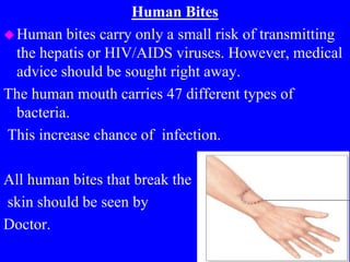 First Aid for Sting and bites | PPT