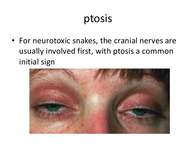 Stings and bites (2)