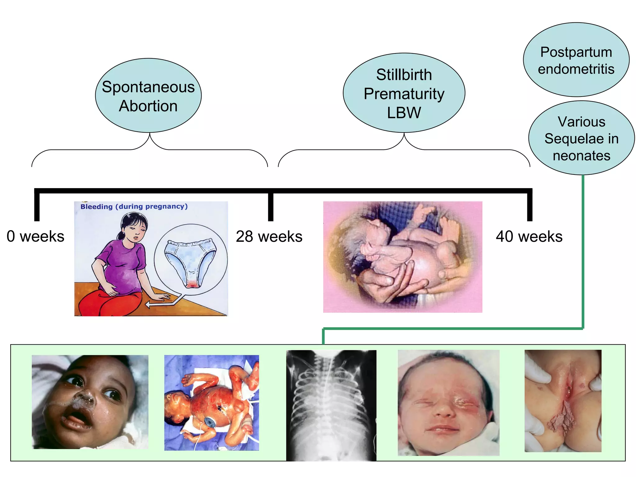 STIs and pregnancy | PPT