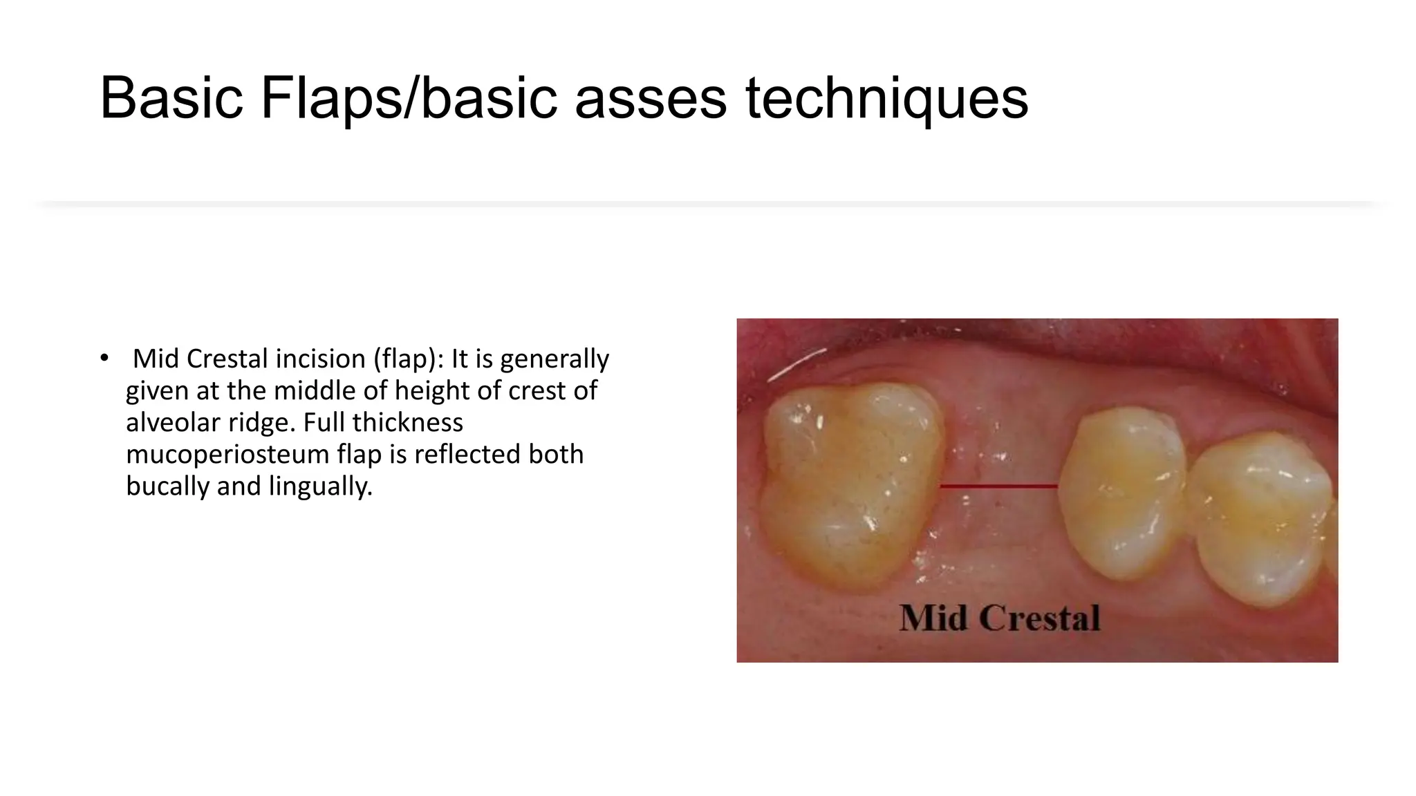 dentla implant soft tissue regenetaion and flap.pptx