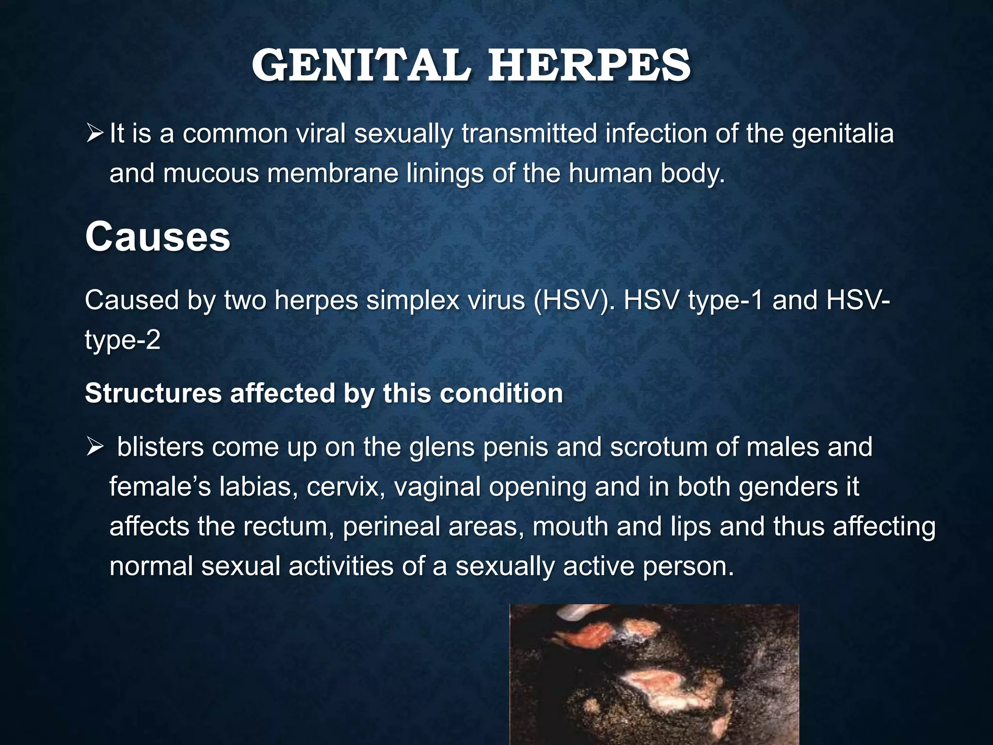 STIs-Genital Ulcer Syndrome presentation. | PPTX