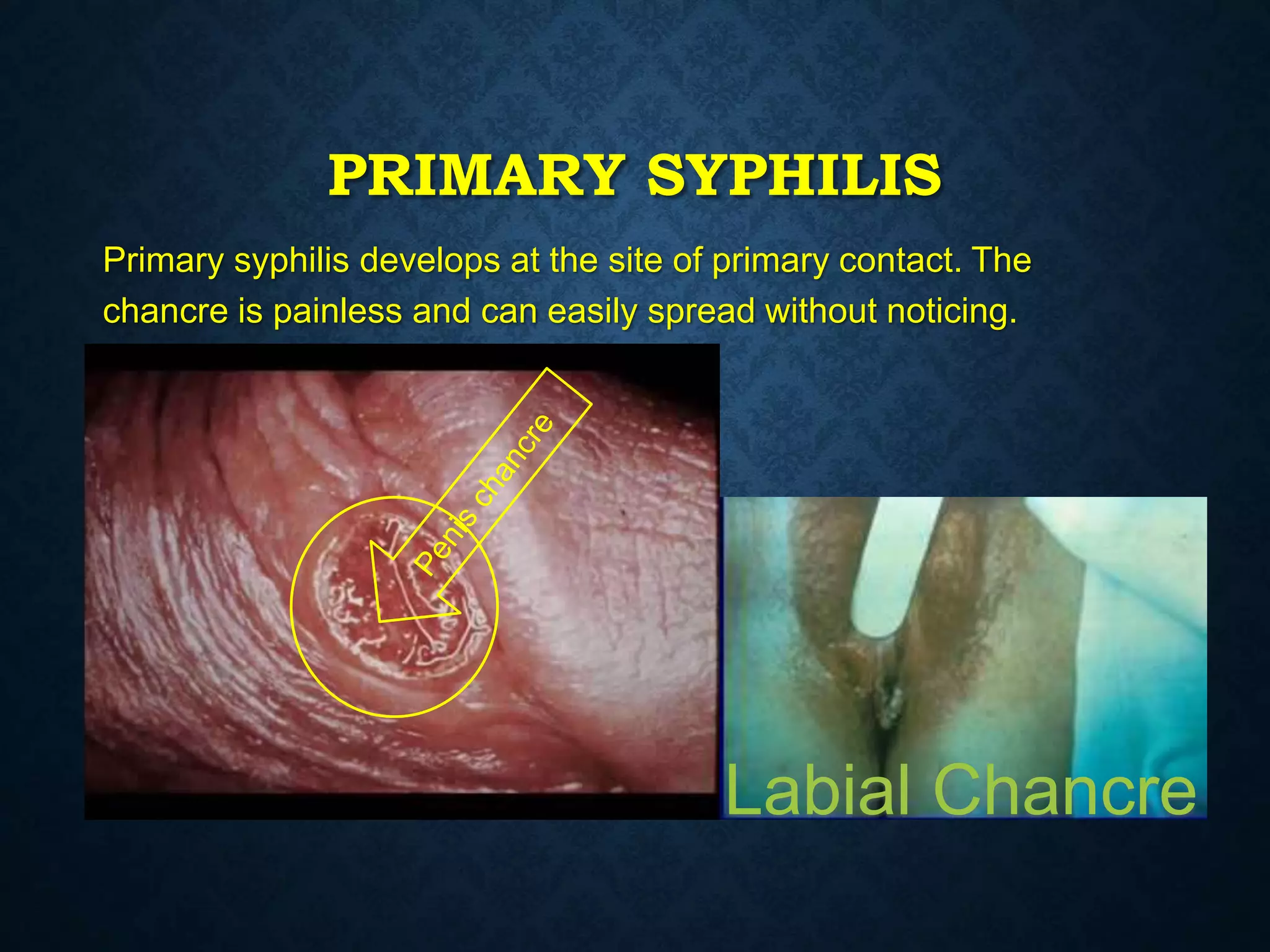 STIs-Genital Ulcer Syndrome presentation. | PPTX
