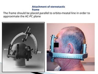 STN Deep brain stimulation in Parkinson's disease | PPTX