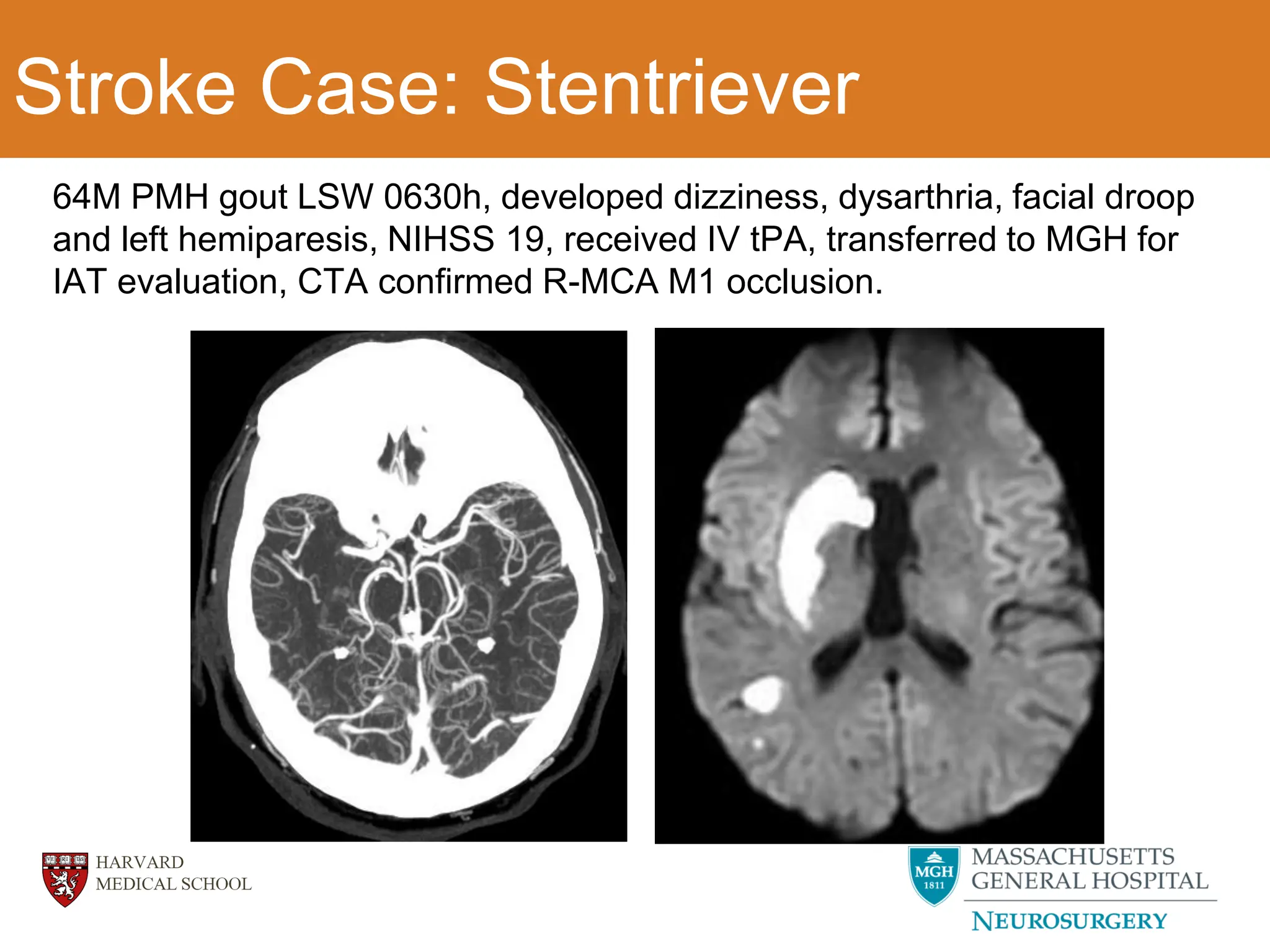 MECHANICAL THROMBECTOMY IN ACUTE ISCHEMIC STROKE | PDF