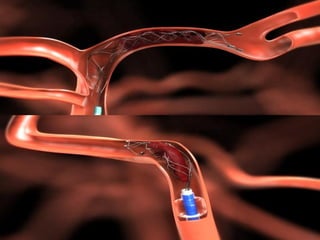 MECHANICAL THROMBECTOMY IN ACUTE ISCHEMIC STROKE | PDF
