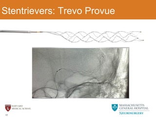 MECHANICAL THROMBECTOMY IN ACUTE ISCHEMIC STROKE | PDF
