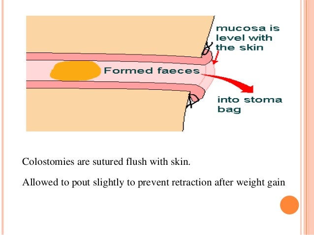 Stoma