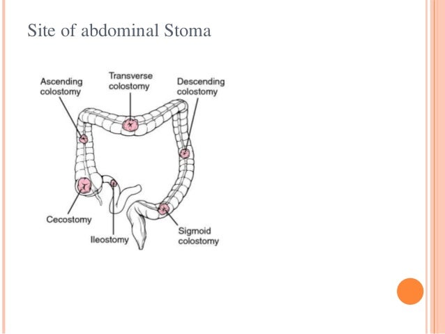 Stoma