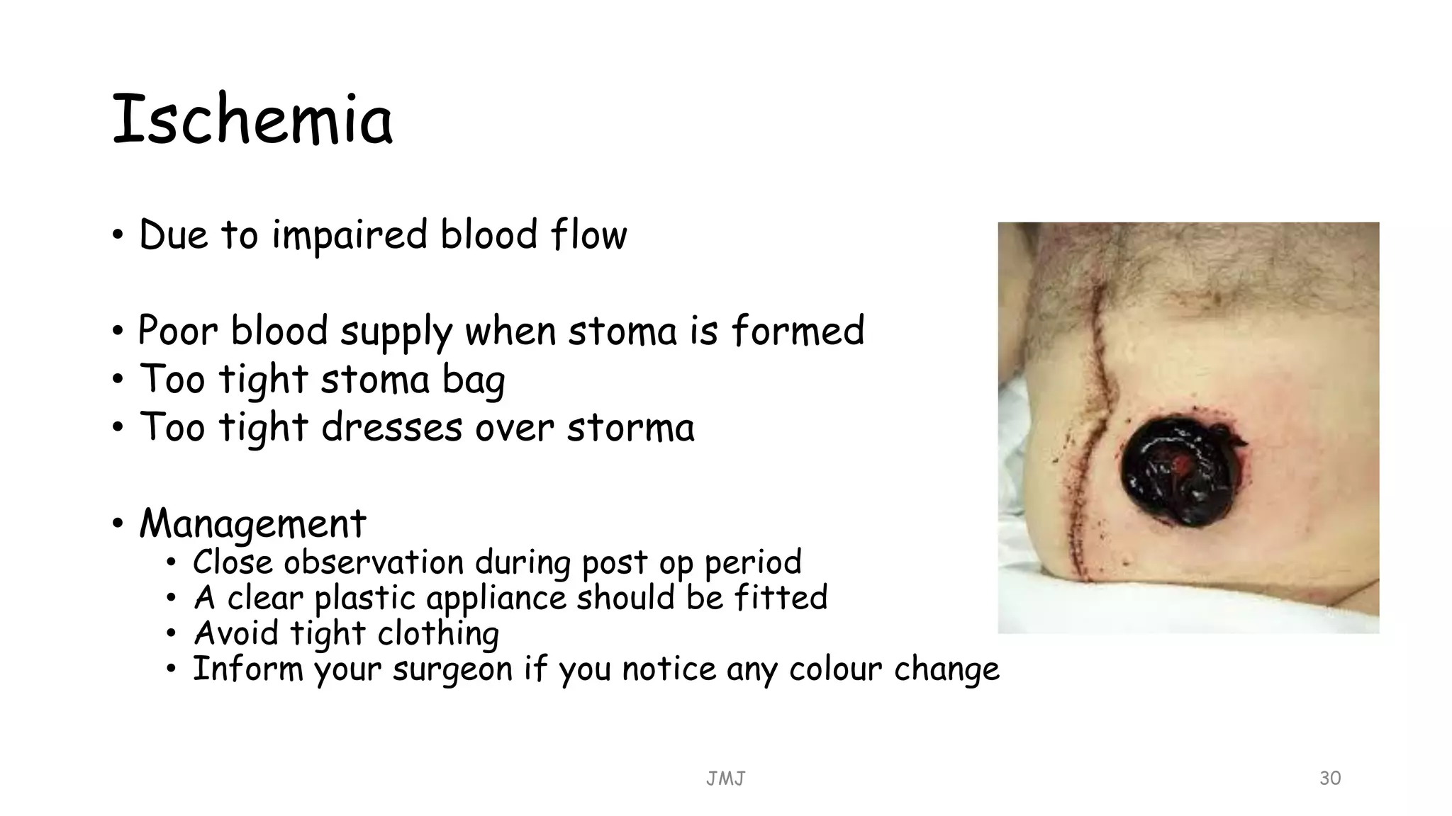 Stoma | PDF