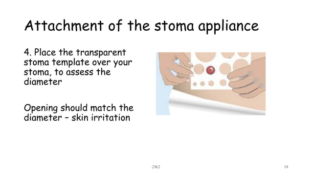 Stoma | PDF