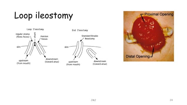 Stoma | PDF