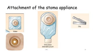 Stoma Appliance