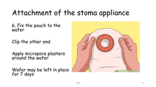 Stoma Appliance