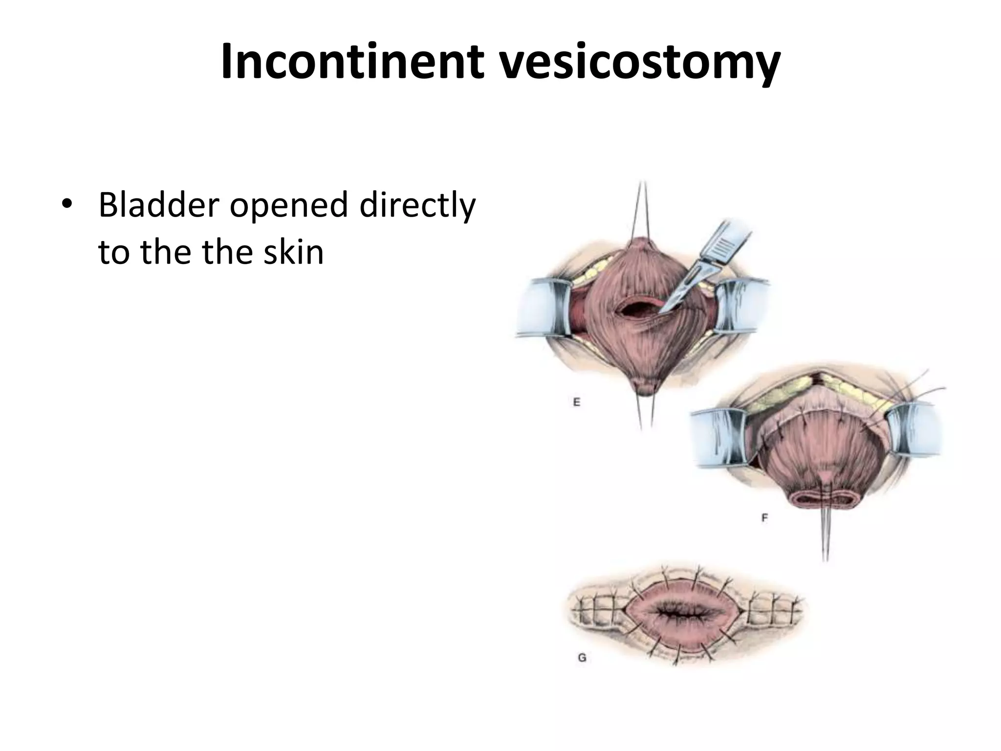 Cutaneous urinary Stoma | PPTX
