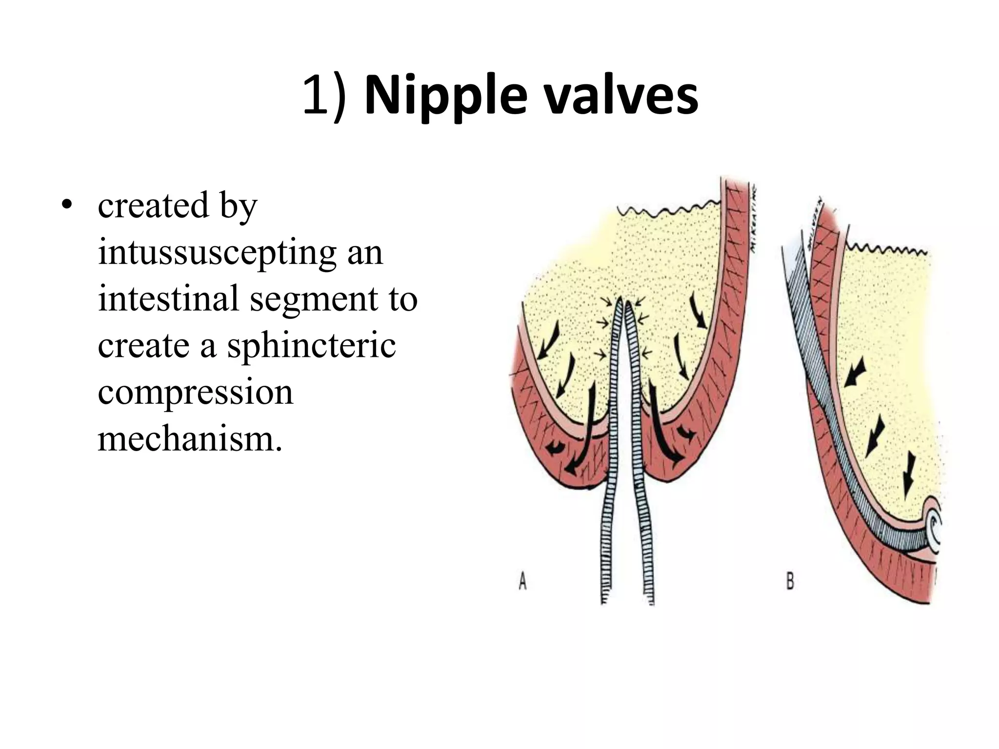 Cutaneous urinary Stoma | PPTX