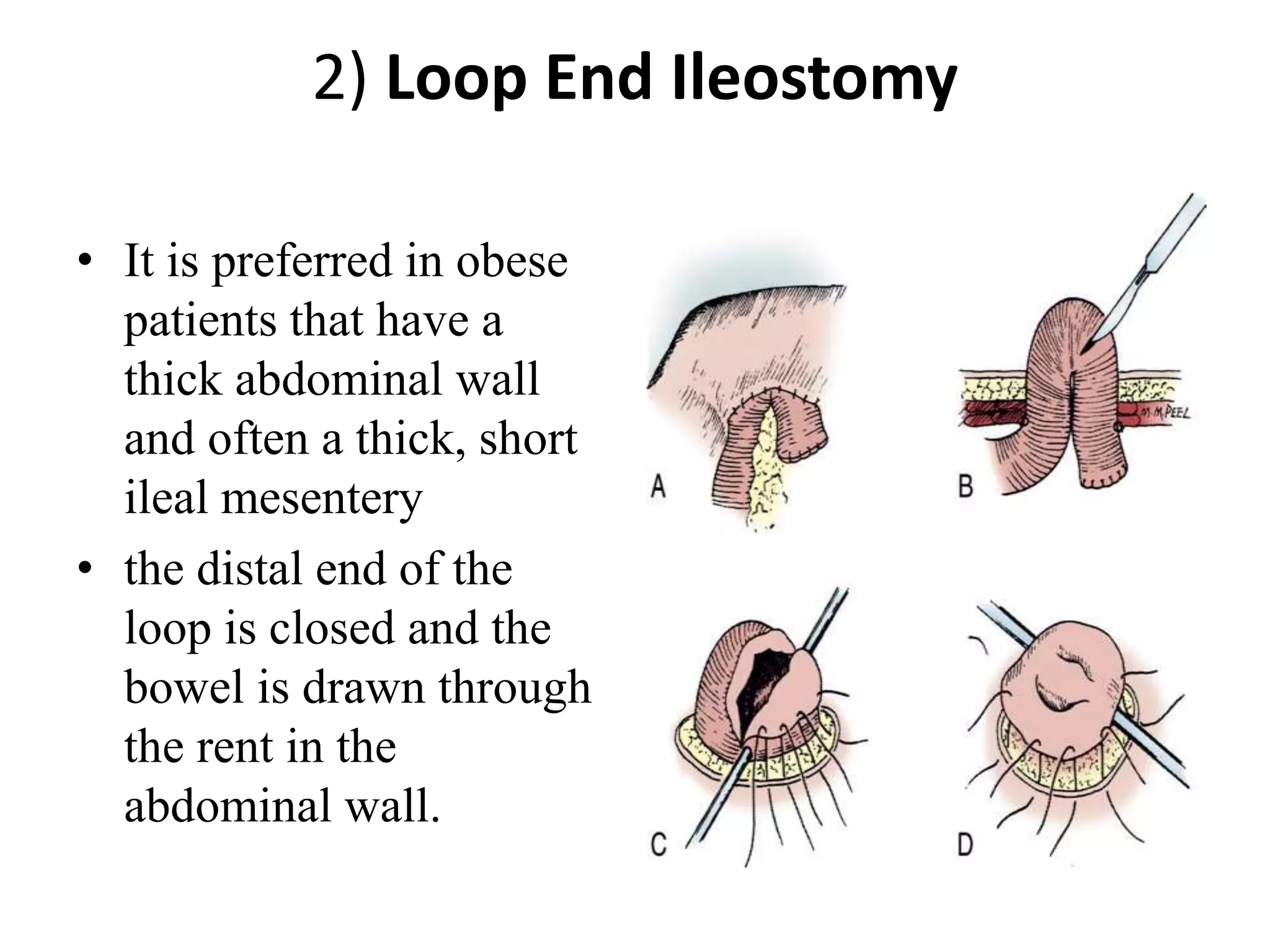 Cutaneous urinary Stoma | PPTX