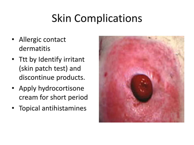 Cutaneous urinary Stoma | PPTX | Digestive Disorders | Diseases and ...