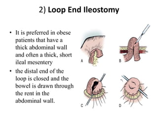 Cutaneous urinary Stoma | PPTX