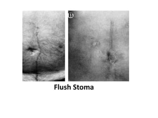 Cutaneous urinary Stoma | PPTX
