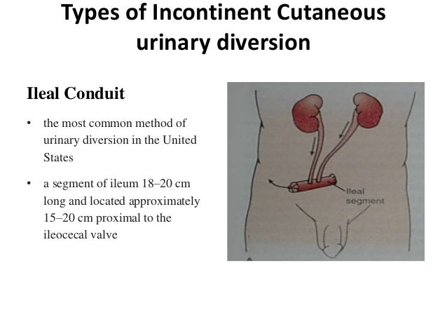 Cutaneous urinary Stoma