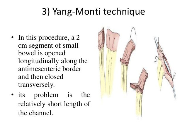 Cutaneous urinary Stoma