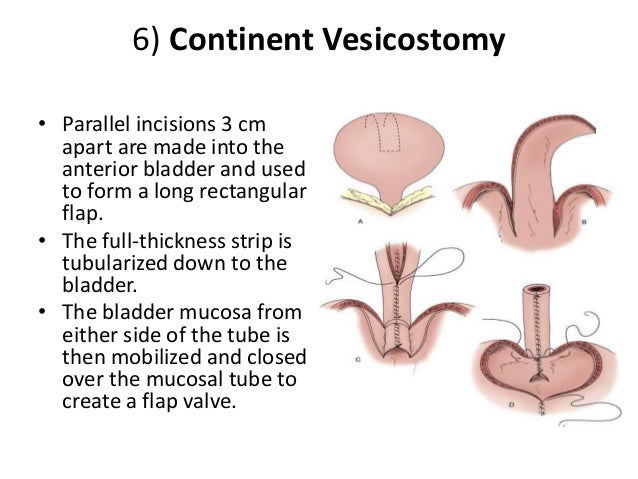 Vesicostomy