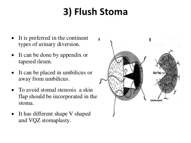 Cutaneous urinary Stoma