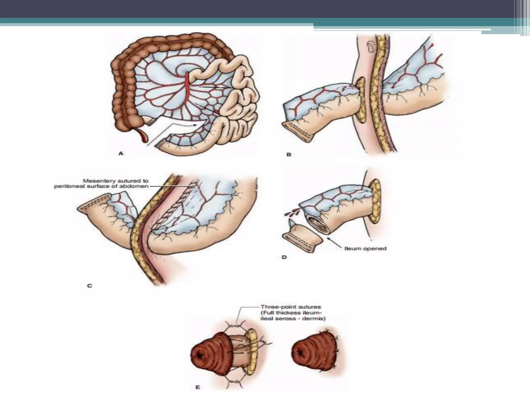 intestinal Stoma | PPTX