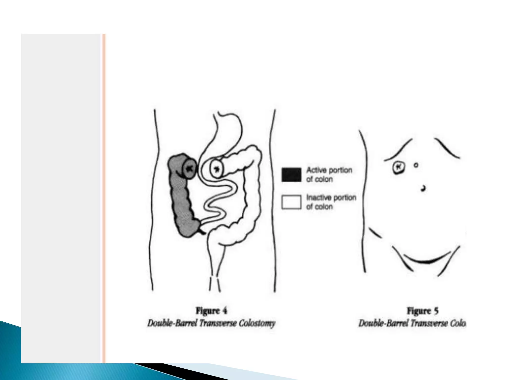 Stoma in surgery | PPT