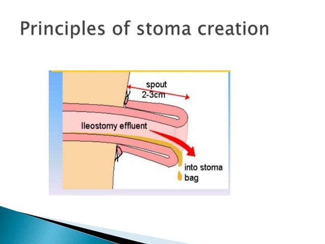 Stoma in surgery | PPT