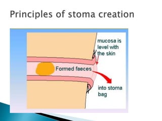 Stoma in surgery | PPT