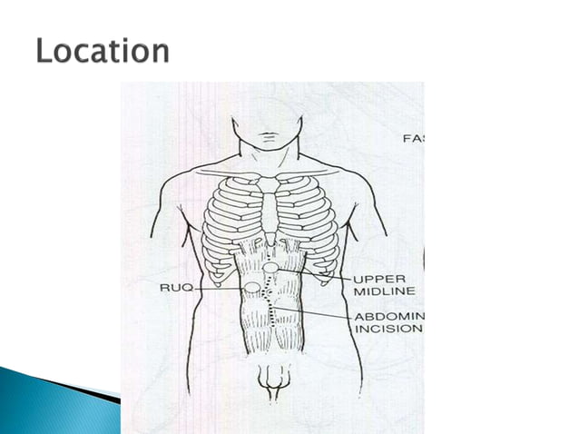 Stoma in surgery | PPT