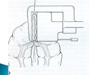 Stoma in surgery | PPT