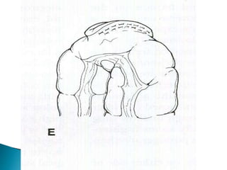 Stoma in surgery | PPT